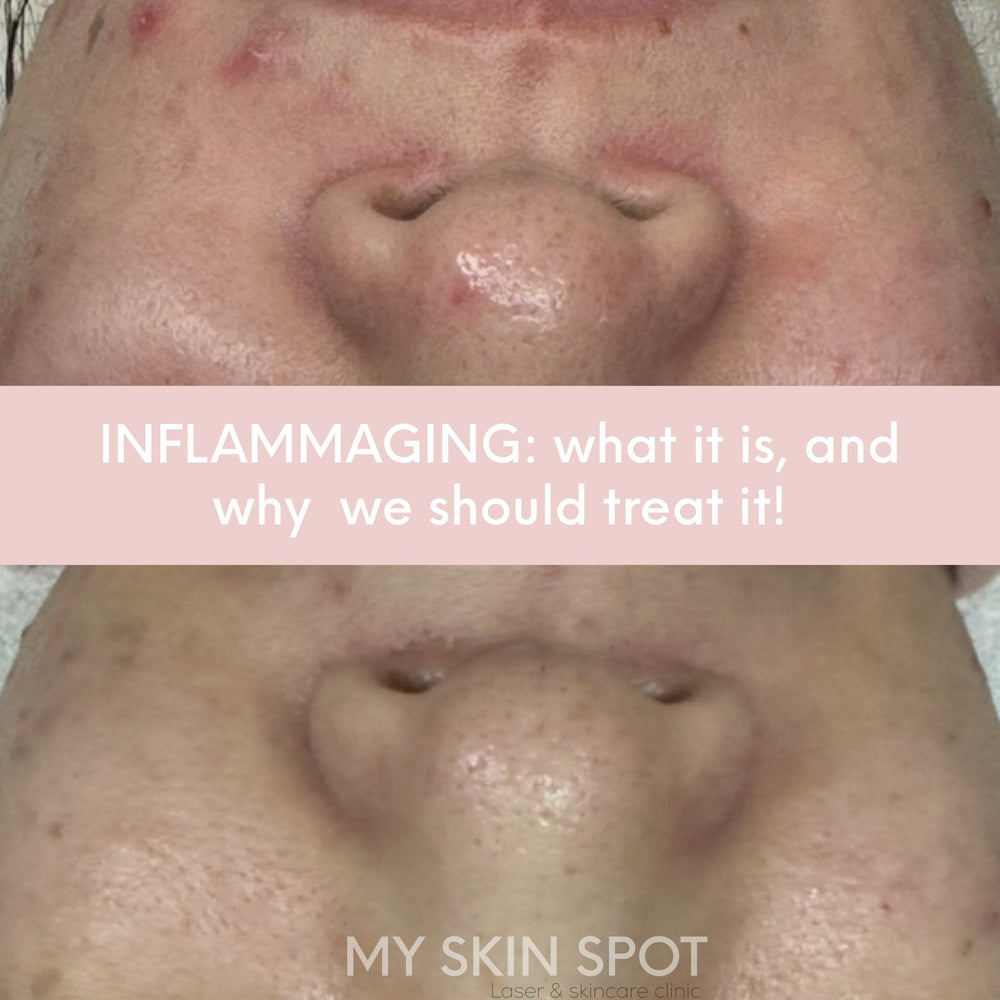 Inflammaging: What is it and why we should treat it | MY SKIN SPOT